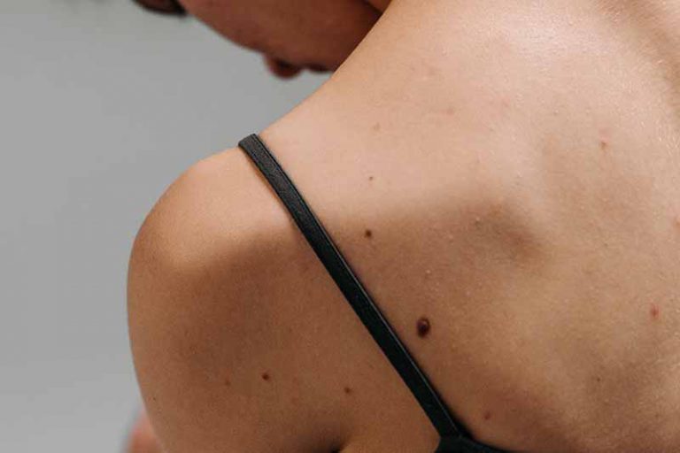 Skin Cancer Signs Spa Service Providers Should Recognize Spa Executive